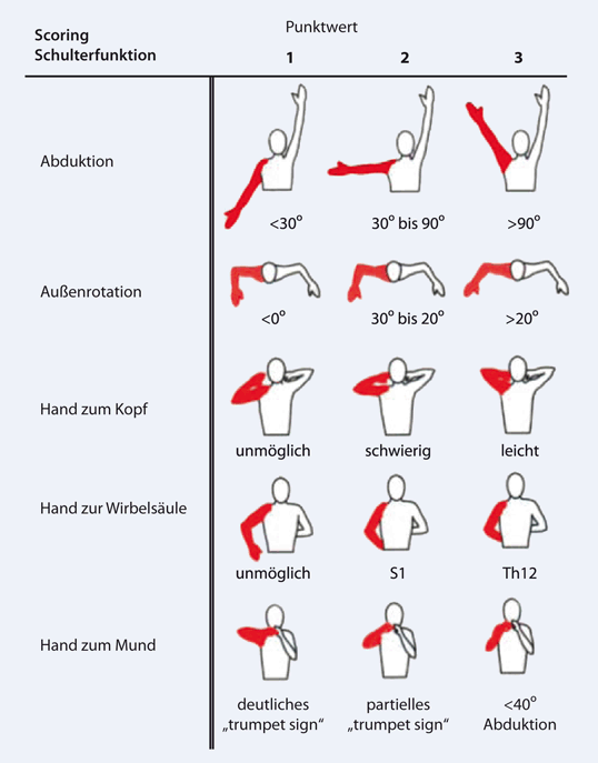Geburtstraumatische Armplexusparesen | SpringerLink