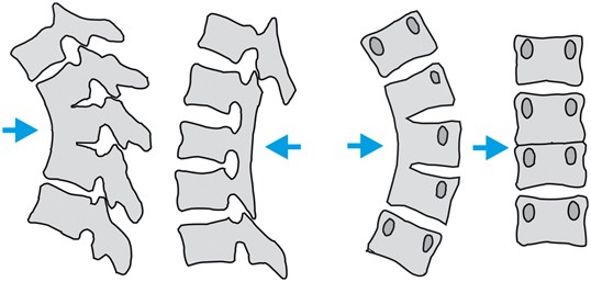 Wirbelsäulenerkrankungen im Kindesalter | SpringerLink