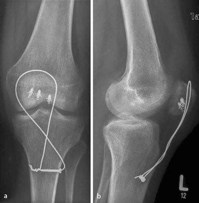 Augmentation von Patellafrakturen und Patellarsehnenrupturen mittels ...