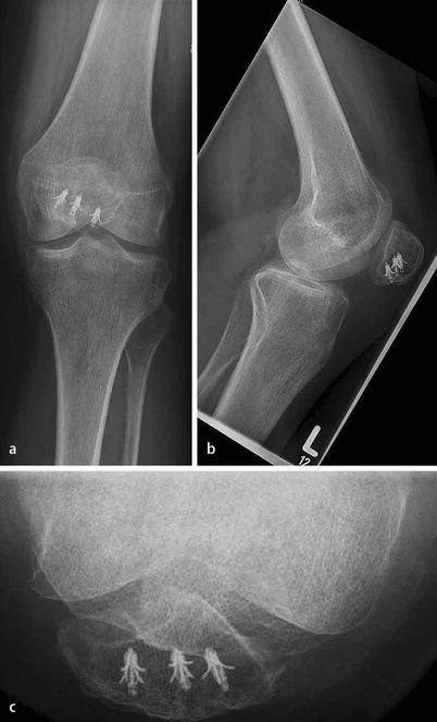 Augmentation von Patellafrakturen und Patellarsehnenrupturen mittels ...