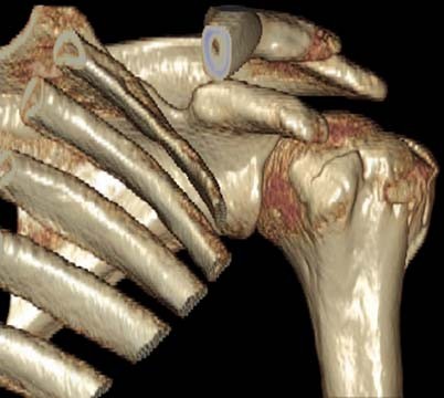 Kombinierte Tuberculum-minus-Avulsion mit Mehrfragmentfraktur des ...