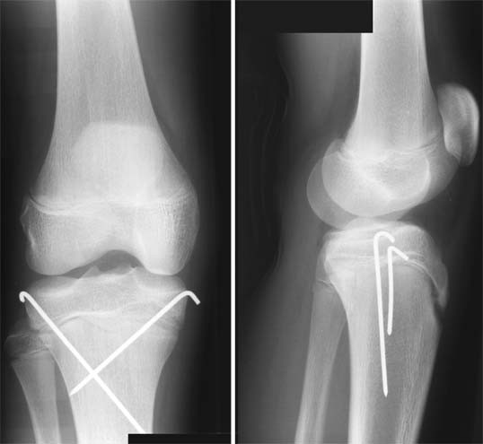 Epiphysenfraktur der proximalen Tibia | SpringerLink