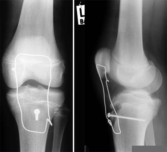 Epiphysenfraktur der proximalen Tibia | SpringerLink