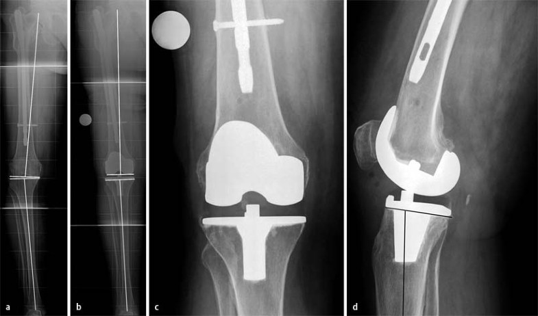Posttraumatische Gonarthrose | SpringerLink