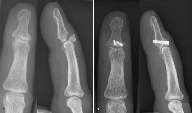 Behandlung von Fingerfrakturen | SpringerLink