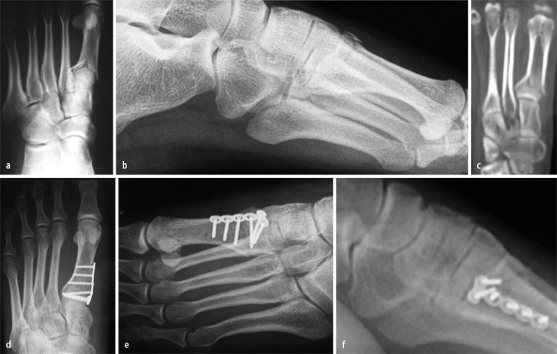 Metatarsale Frakturen | SpringerLink