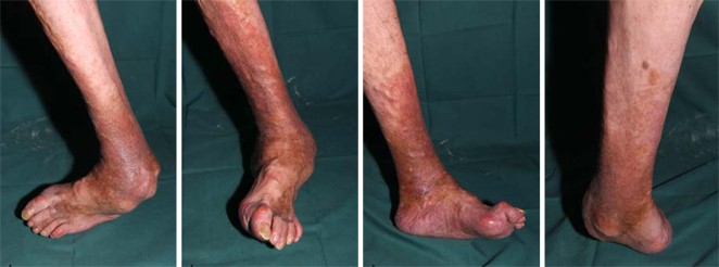 Der Taylor-spatial-frame-Fixateur | SpringerLink