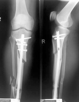 Marknagelosteosynthese proximaler Tibiafrakturen | SpringerLink