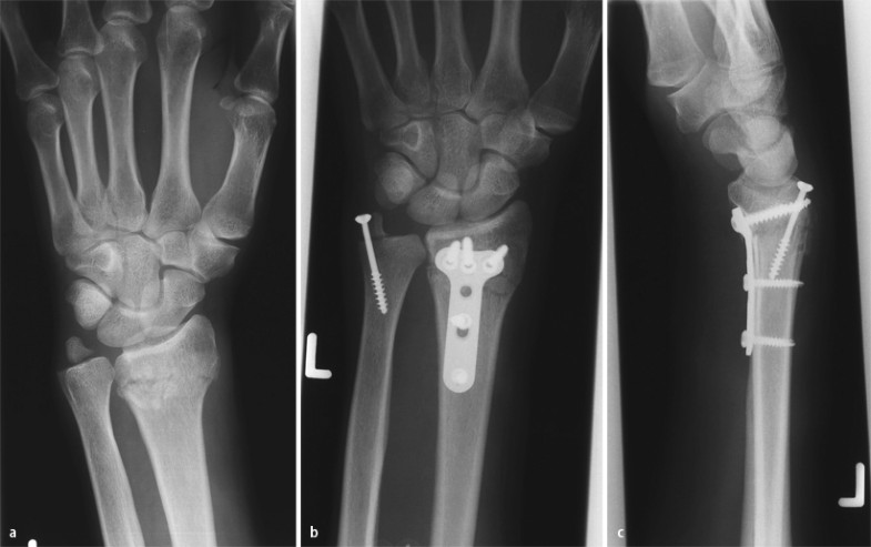 Begleitverletzungen distaler Radiusfrakturen | SpringerLink