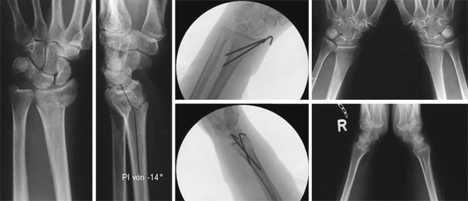 Langzeitergebnisse nach Kirschner-Draht-Osteosynthese distaler ...