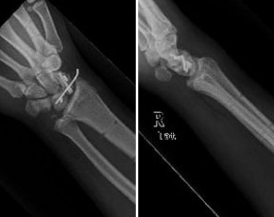 Beidseitige perilunäre Luxationsfraktur bei einem polytraumatisierten ...