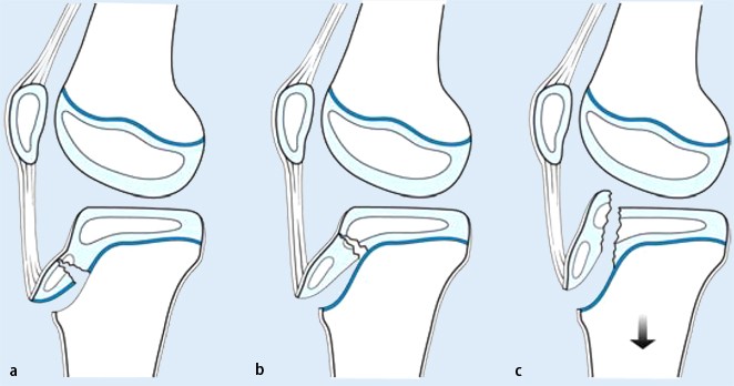 Frakturen der proximalen Tibia | SpringerLink