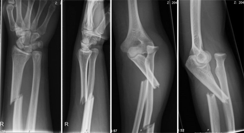 Kombinierte Monteggia- und Galeazzi-Läsionen des Unterarms | SpringerLink