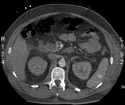 Zweizeitige Milzruptur am 13. postraumatischen Tag nach initial ...