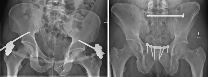 Anteriore Zugänge zum Beckenring | SpringerLink