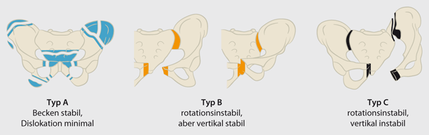 Insuffizienzfrakturen des Beckenrings | SpringerLink