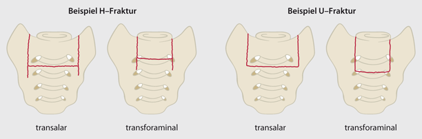 Insuffizienzfrakturen des Beckenrings | SpringerLink