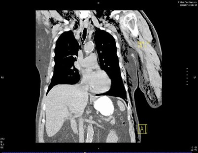 Benignes subkutanes Emphysem nach Nagelpenetration | SpringerLink