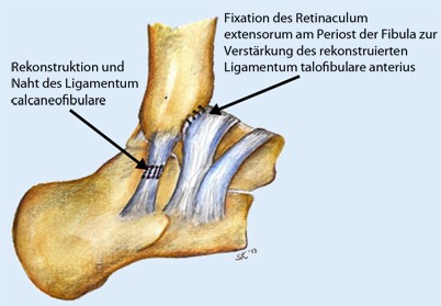 Die Verletzung des lateralen Kapsel-Band-Apparats des Sprunggelenks ...