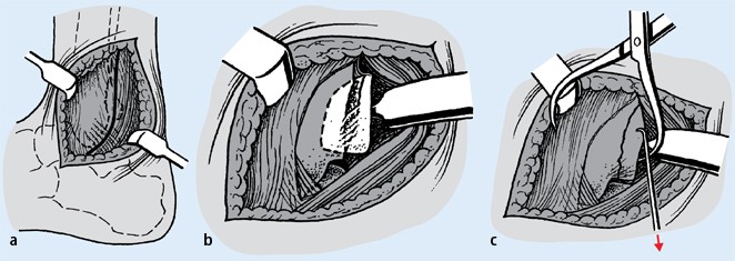 Der posteriore Malleolus bzw. das Volkmann-Dreieck | SpringerLink