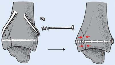 Der posteriore Malleolus bzw. das Volkmann-Dreieck | SpringerLink