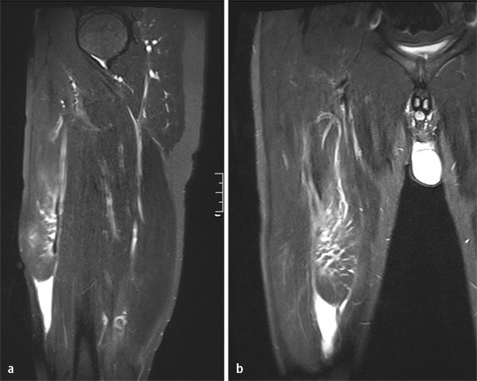 MRT-Untersuchungen bei Muskelverletzungen | SpringerLink