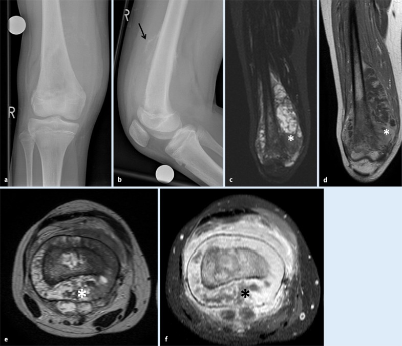 Bildgebende Diagnostik der Knochensarkome | SpringerLink