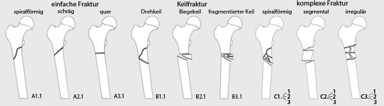 Subtrochantäre Femurfrakturen | SpringerLink