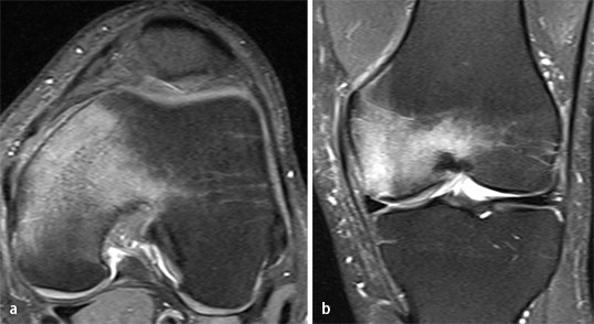 Therapie bei Knochenmarködemsyndrom im Kniegelenk mit Denosumab ...