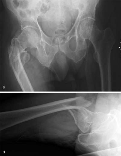 Pertrochantäre Femurfrakturen beim geriatrischen Patienten | SpringerLink