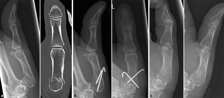 Frakturen des Daumenstrahls | SpringerLink