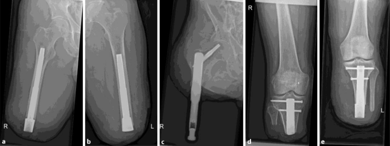 Osseointegrated prosthesis for patients with an amputation | SpringerLink