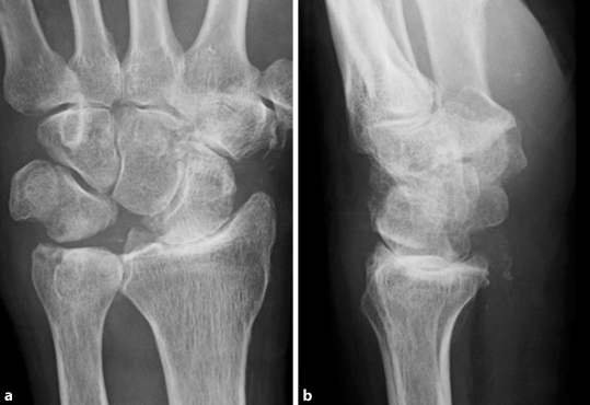 Die Kompression des Nervus medianus durch ein luxiertes Mondbein ...
