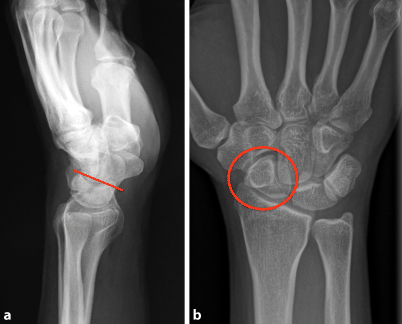 Mediokarpale Instabilitäten der Handwurzel | SpringerLink