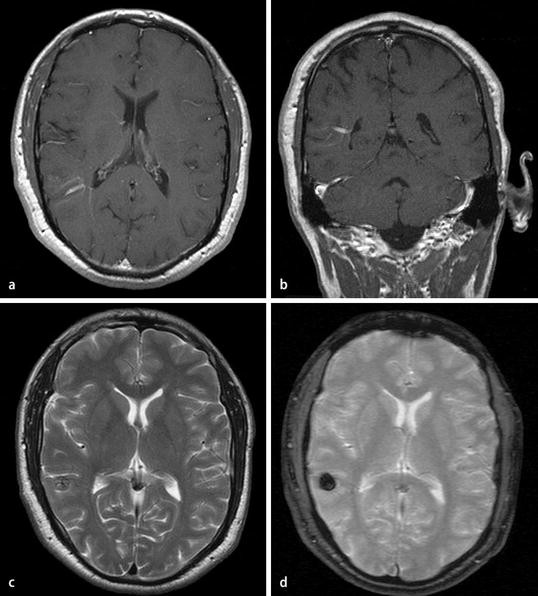 Developmental Venous Anomaly (DVA) | SpringerLink