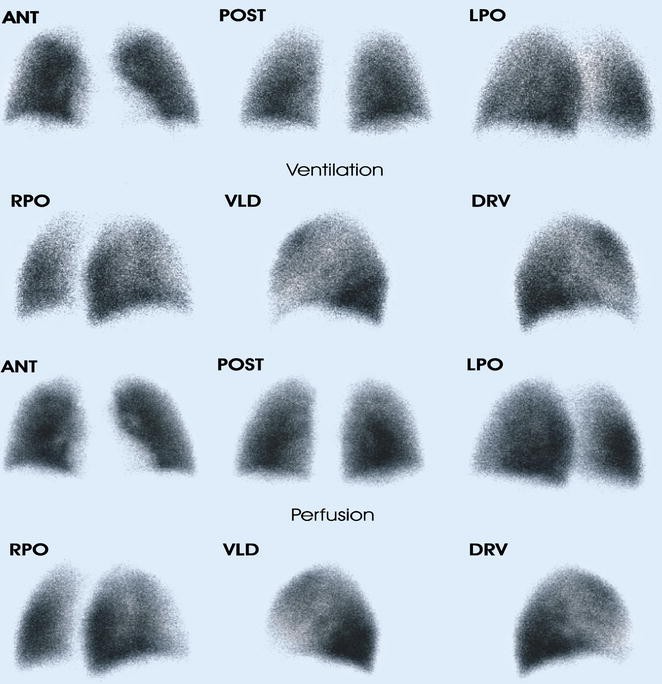 Pulmonale Perfusions- und Ventilationsszintigraphie in der Diagnostik ...