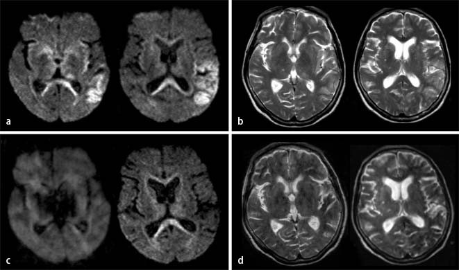 Postiktale MR-Veränderungen | SpringerLink