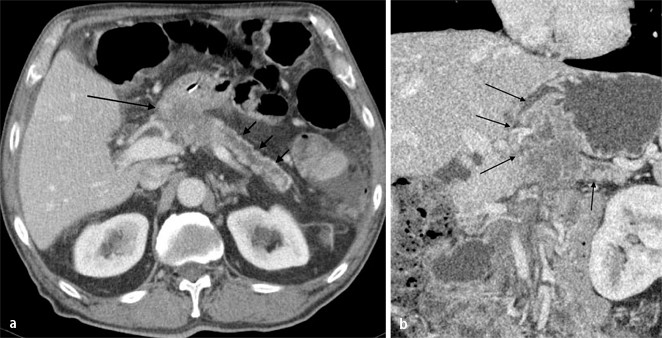 Computertomographie bei Pankreastumoren | SpringerLink