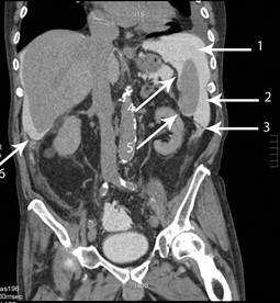 Peritoneum und Mesenterium | SpringerLink
