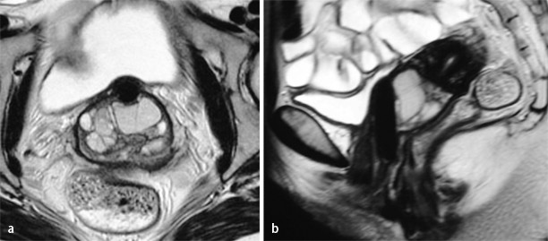 Tumoren des weiblichen Beckens | SpringerLink