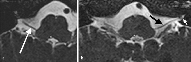Anatomie der Schädelbasis und Hirnnerven in der Schnittbildgebung ...