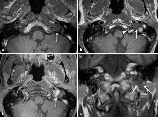 Hirnnerven – Perineurale Tumorausbreitung | SpringerLink
