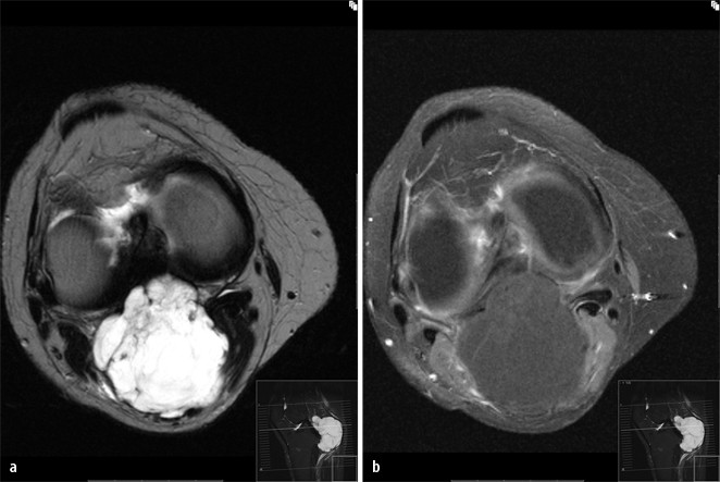 Persistierende Knieschmerzen und palpabler Tumor in der Kniekehle ...
