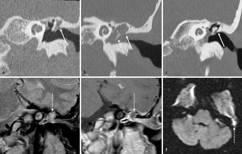 Bildgebung des Schläfenbeins | SpringerLink