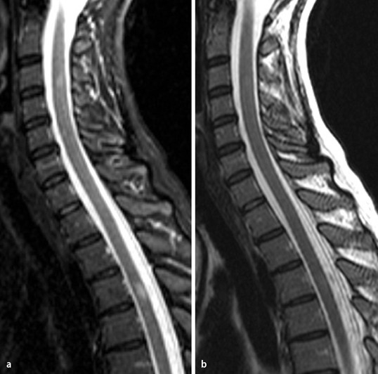 Bildgebung bei demyelinisierenden und tumorösen Erkrankungen des ...