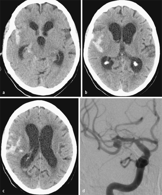 Bildgebende Diagnostik der Subarachnoidalblutung | SpringerLink