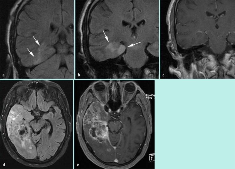 Intraaxiale Hirntumoren | SpringerLink