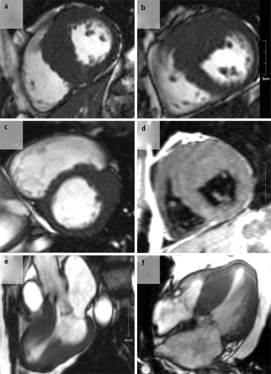 MRT-Bildgebung bei hypertropher Kardiomyopathie (HCM) | SpringerLink