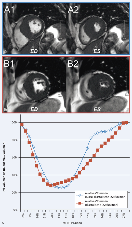 MRT-Bildgebung bei hypertropher Kardiomyopathie (HCM) | SpringerLink