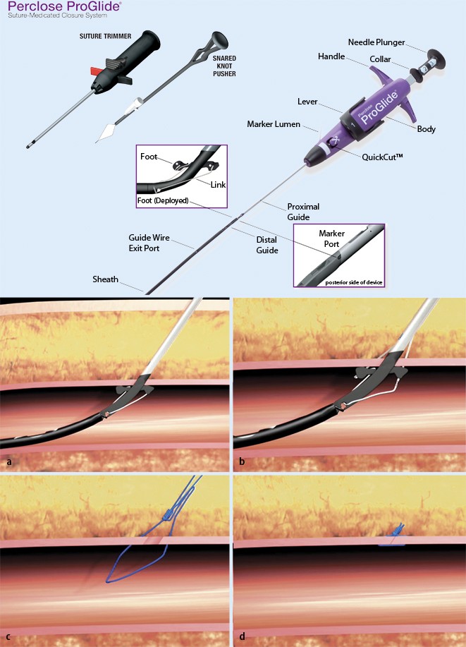 Arterielle Verschlusssysteme | SpringerLink